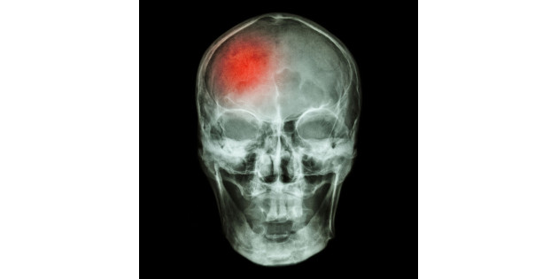 AVC : un biomarqueur pour guider la décision médicale